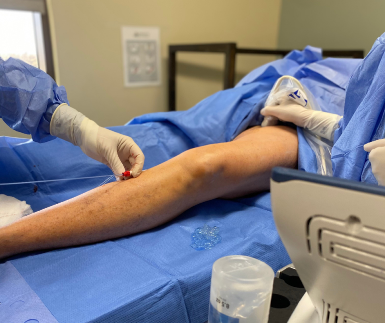 Visual Sclerotherapy - San Diego Vein Specialists